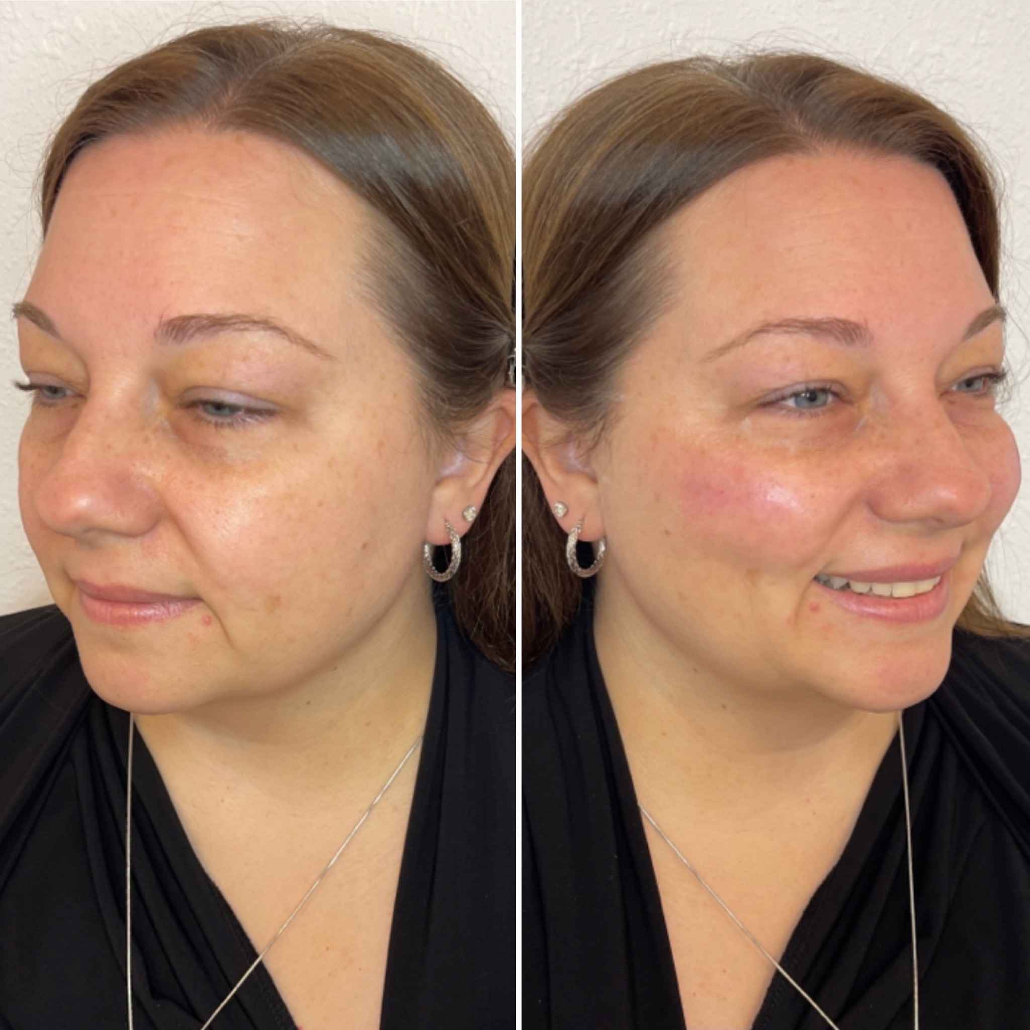 Med Spa Before and After Photos | Onyx Medical Aesthetics WA