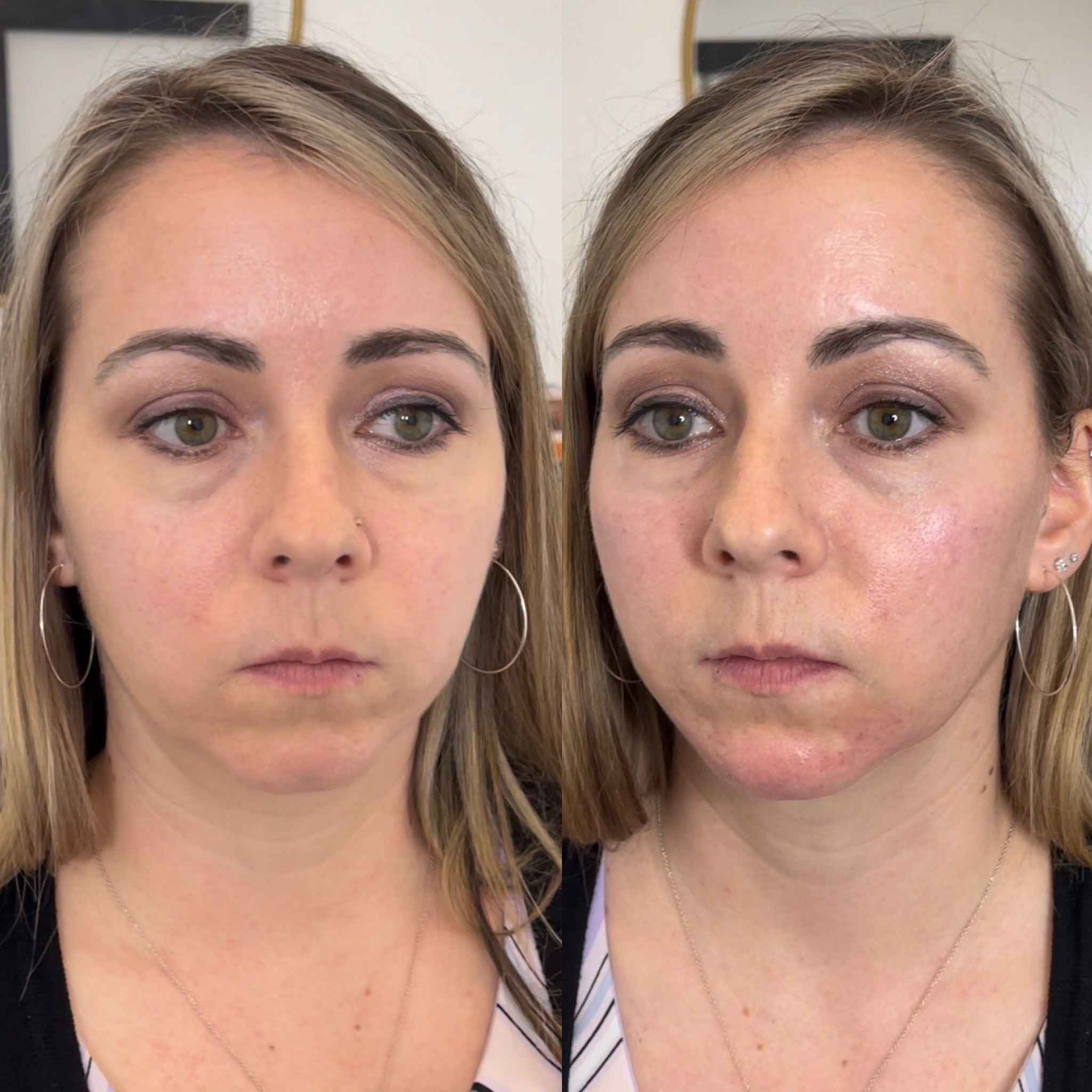 Med Spa Before and After Photos | Onyx Medical Aesthetics WA