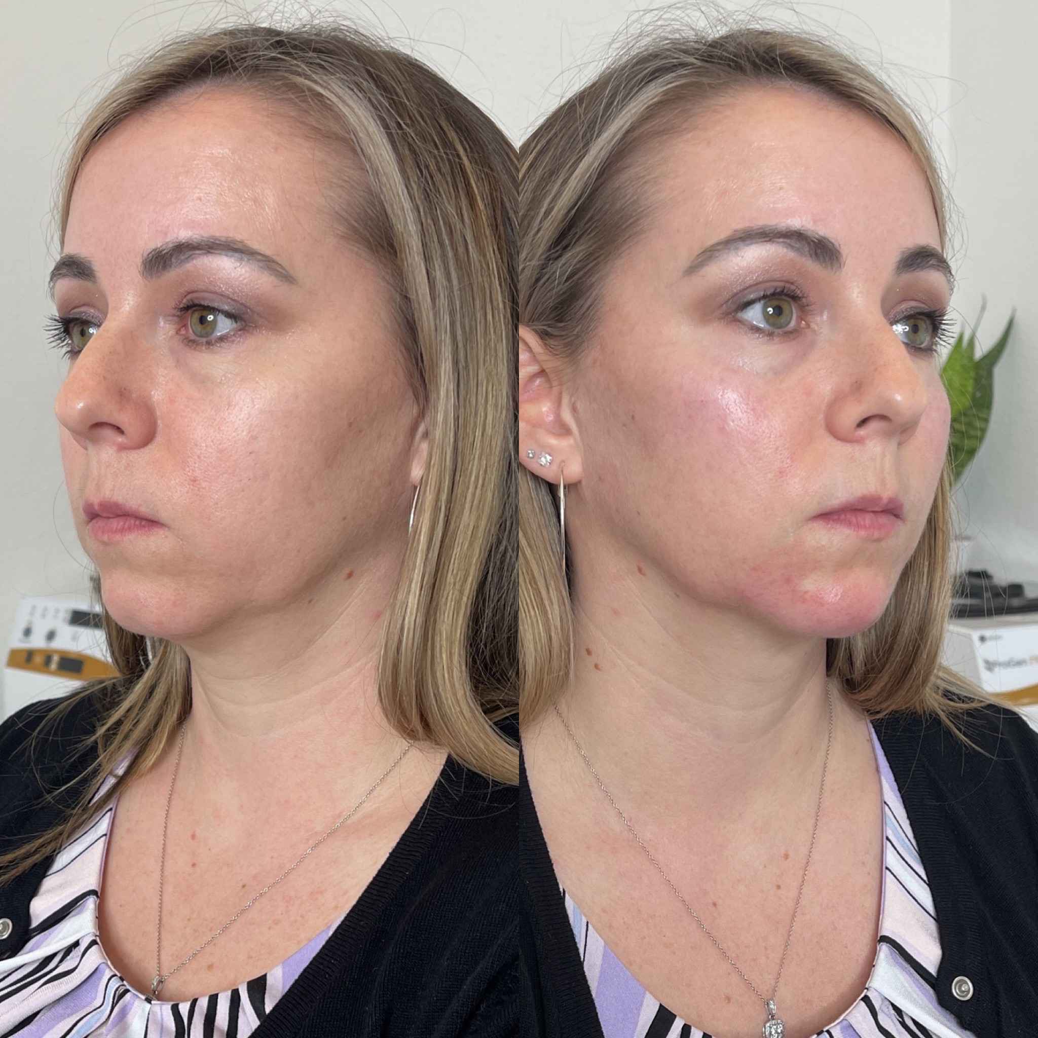 Med Spa Before and After Photos | Onyx Medical Aesthetics WA