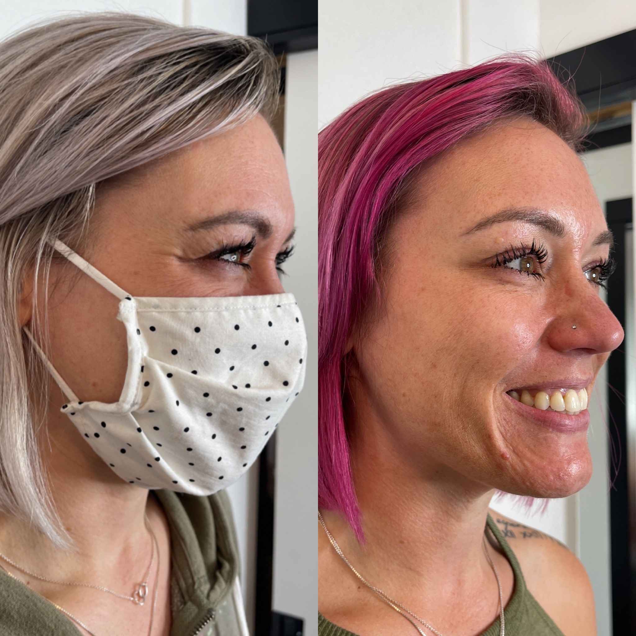 Med Spa Before and After Photos | Onyx Medical Aesthetics WA