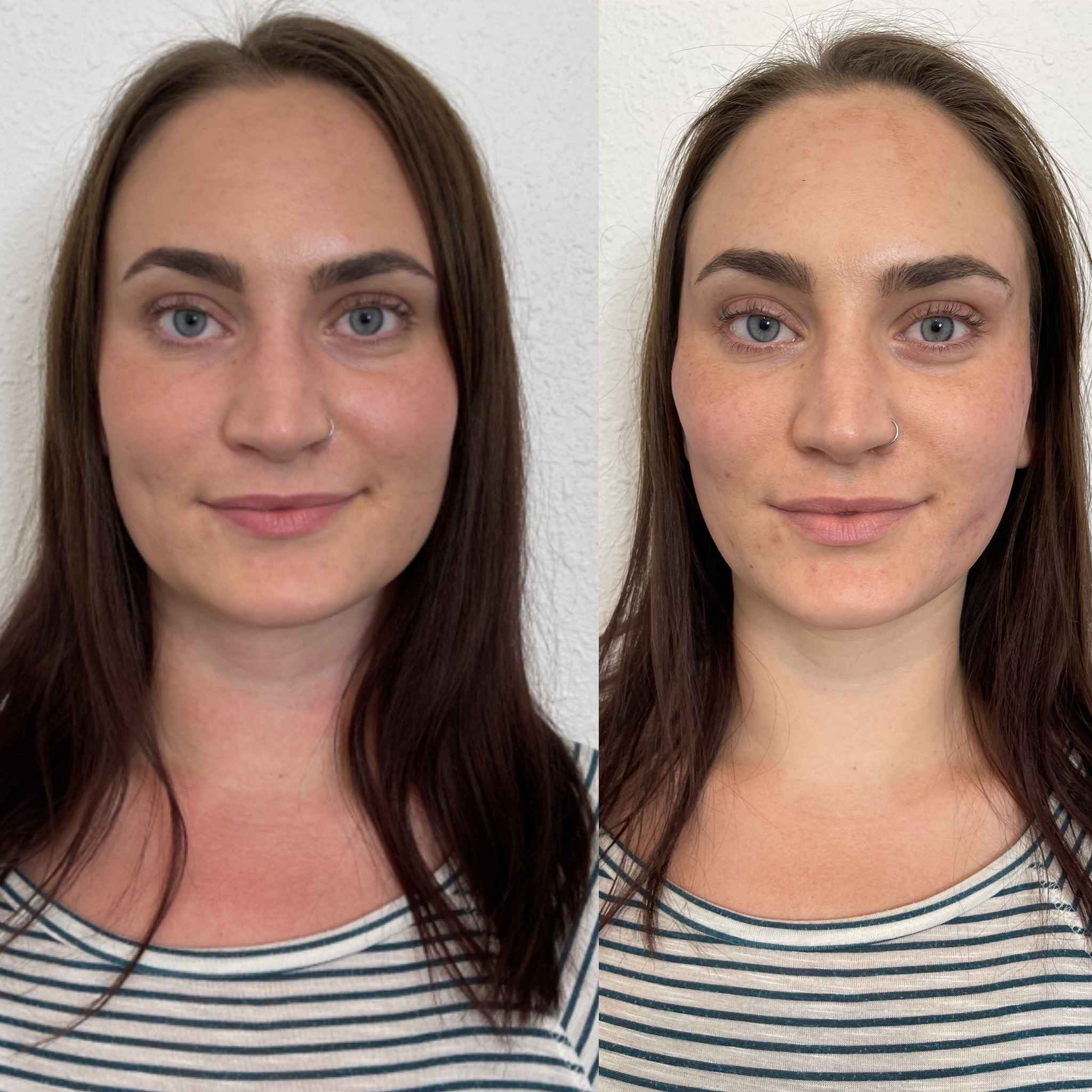Med Spa Before and After Photos | Onyx Medical Aesthetics WA