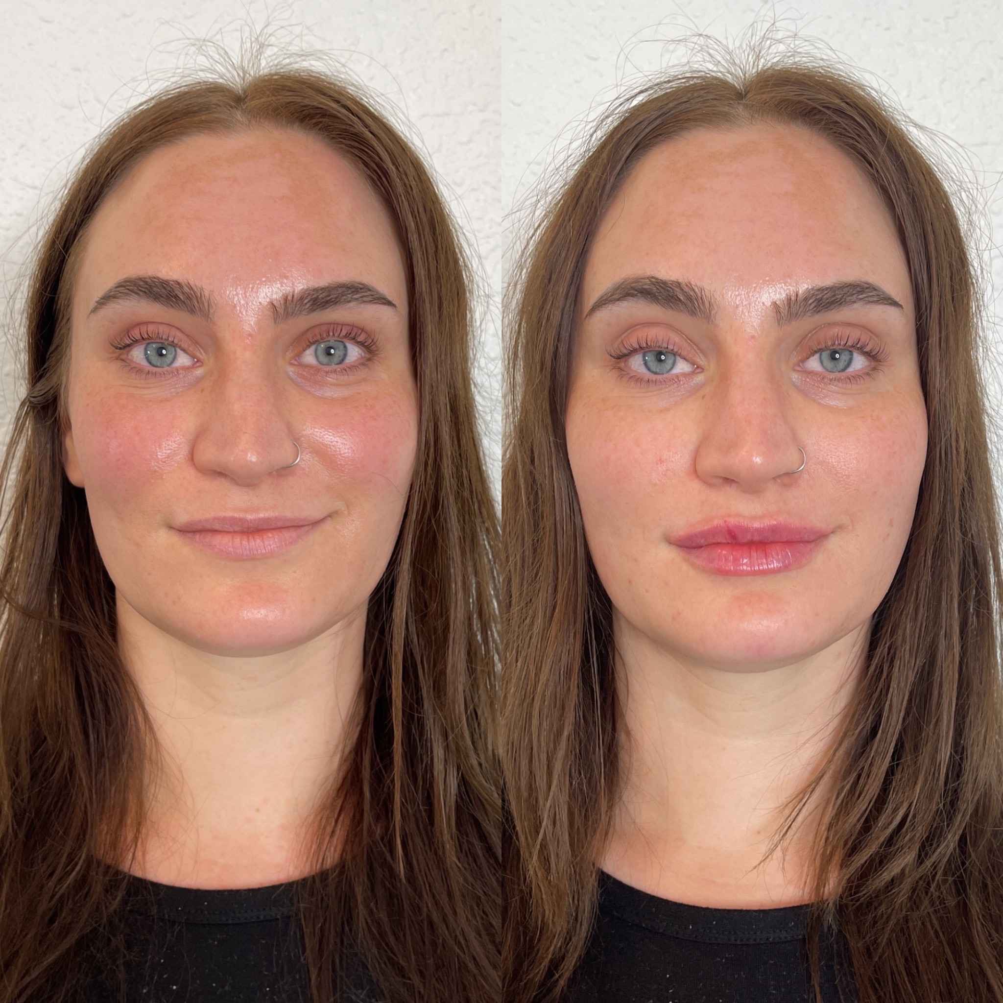 Med Spa Before and After Photos | Onyx Medical Aesthetics WA