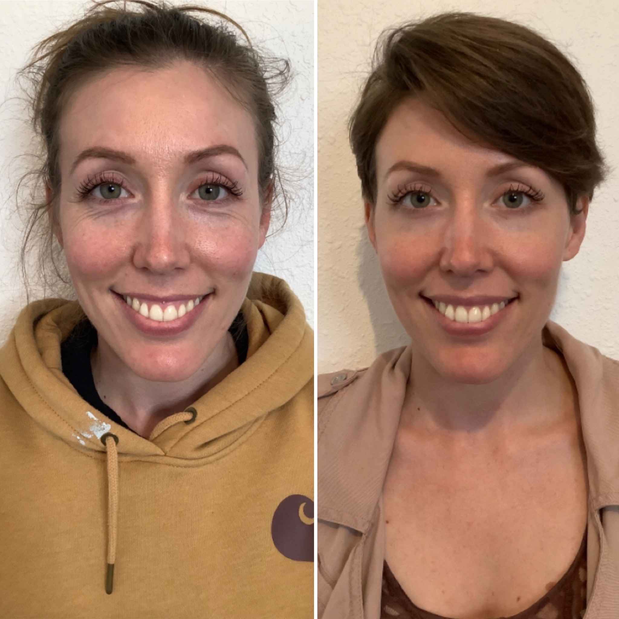 Med Spa Before and After Photos | Onyx Medical Aesthetics WA