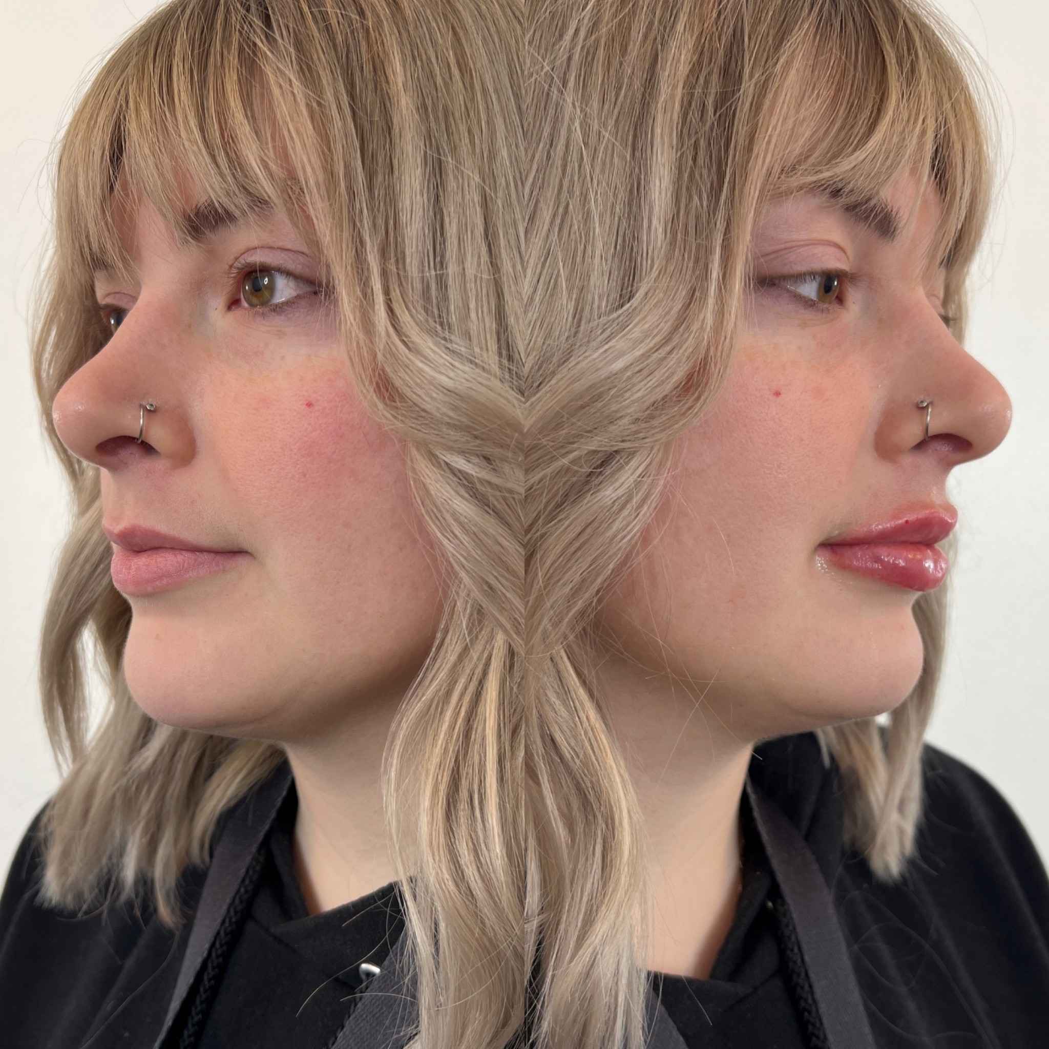 Med Spa Before and After Photos | Onyx Medical Aesthetics WA