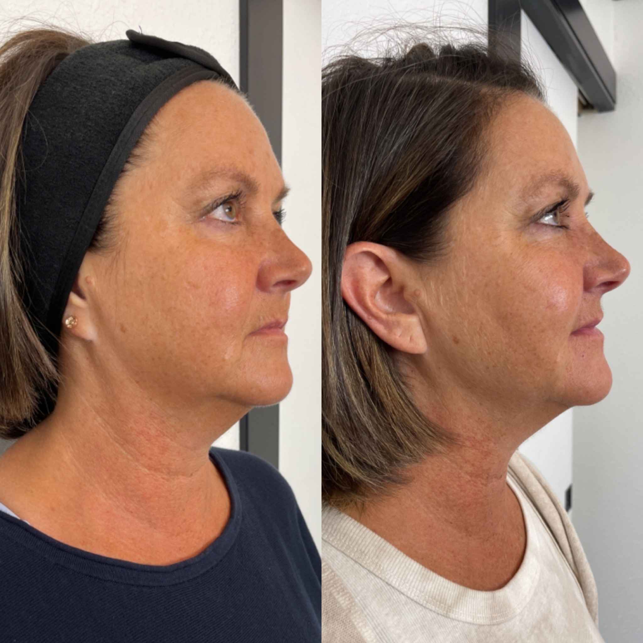 Med Spa Before and After Photos | Onyx Medical Aesthetics WA