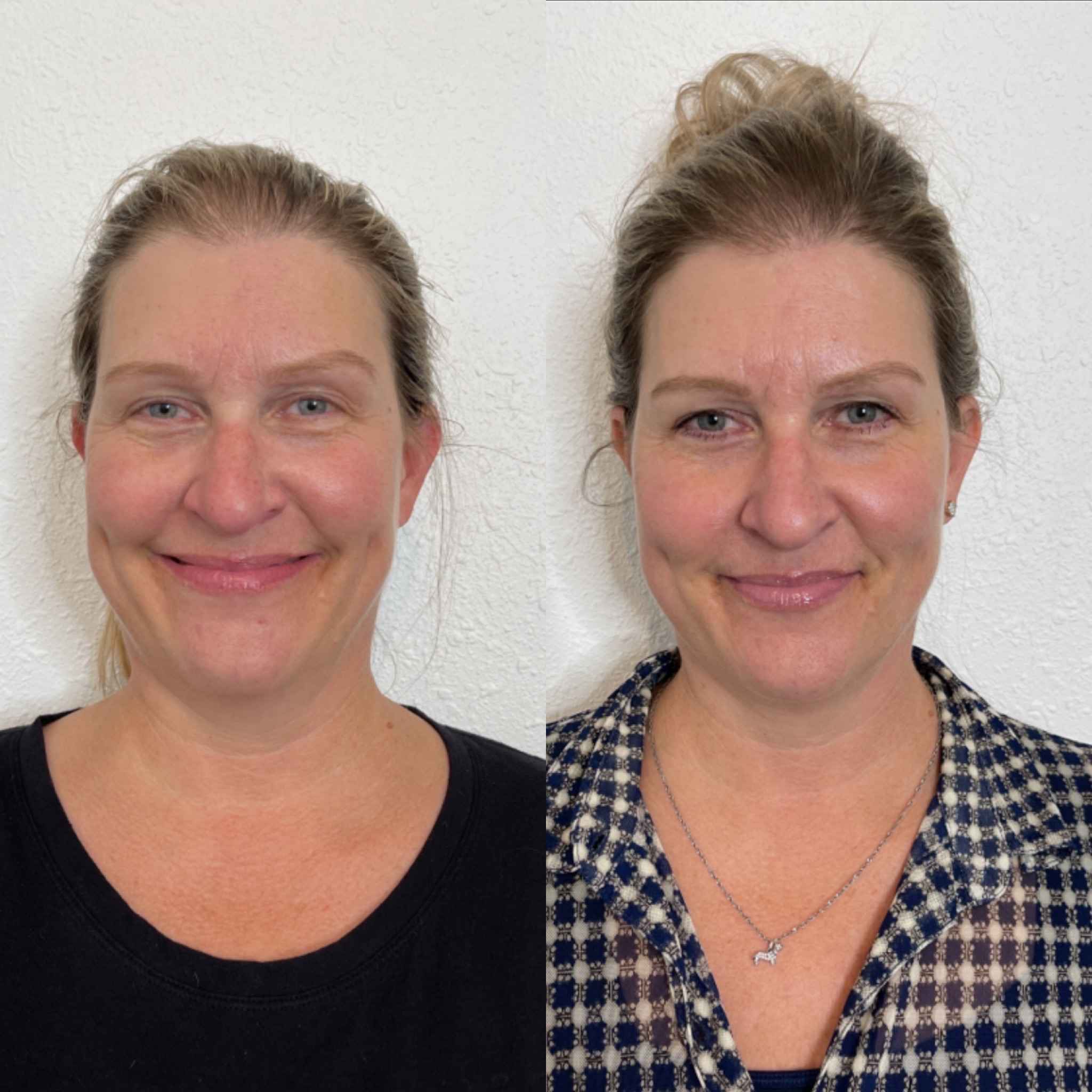 Med Spa Before and After Photos | Onyx Medical Aesthetics WA