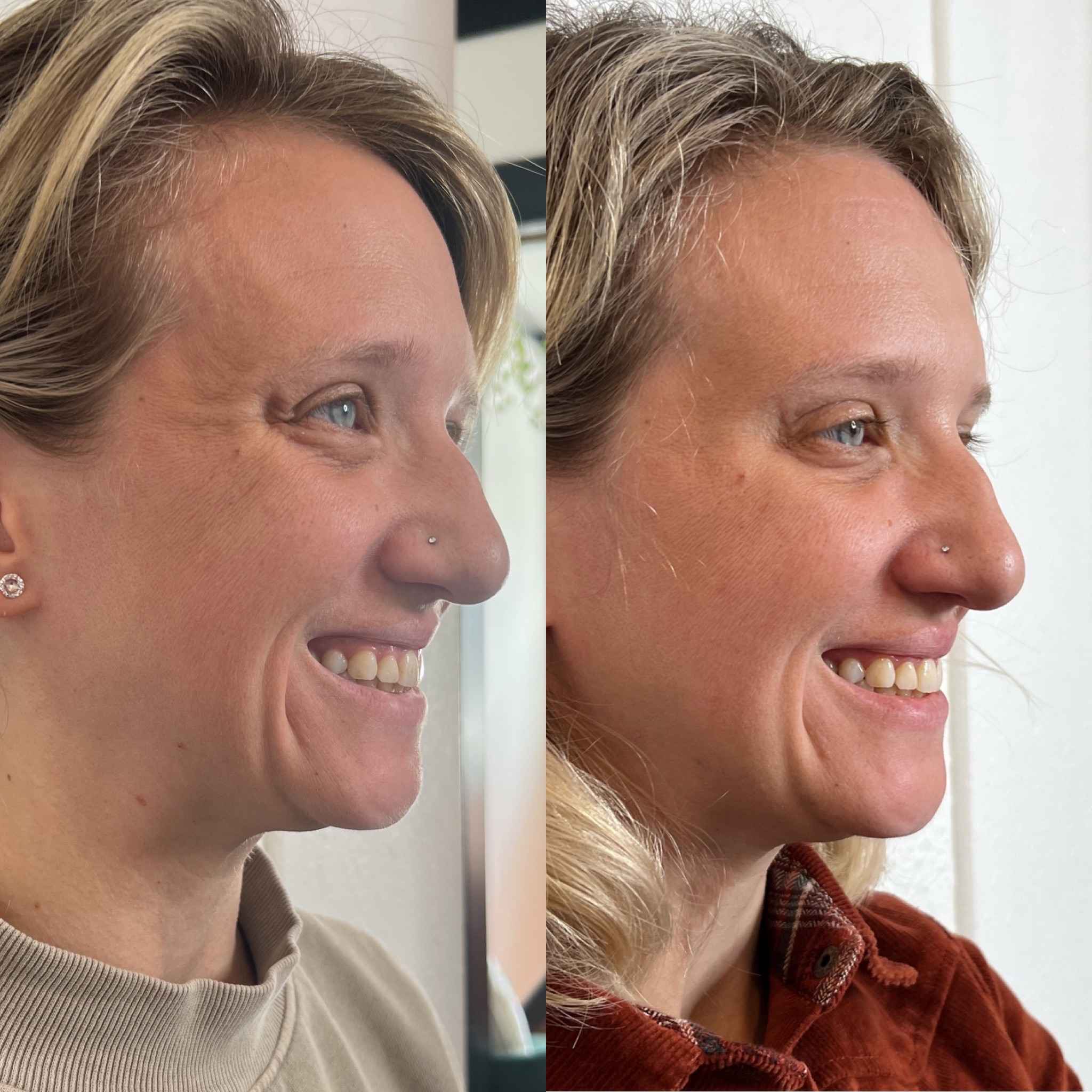 Med Spa Before and After Photos | Onyx Medical Aesthetics WA