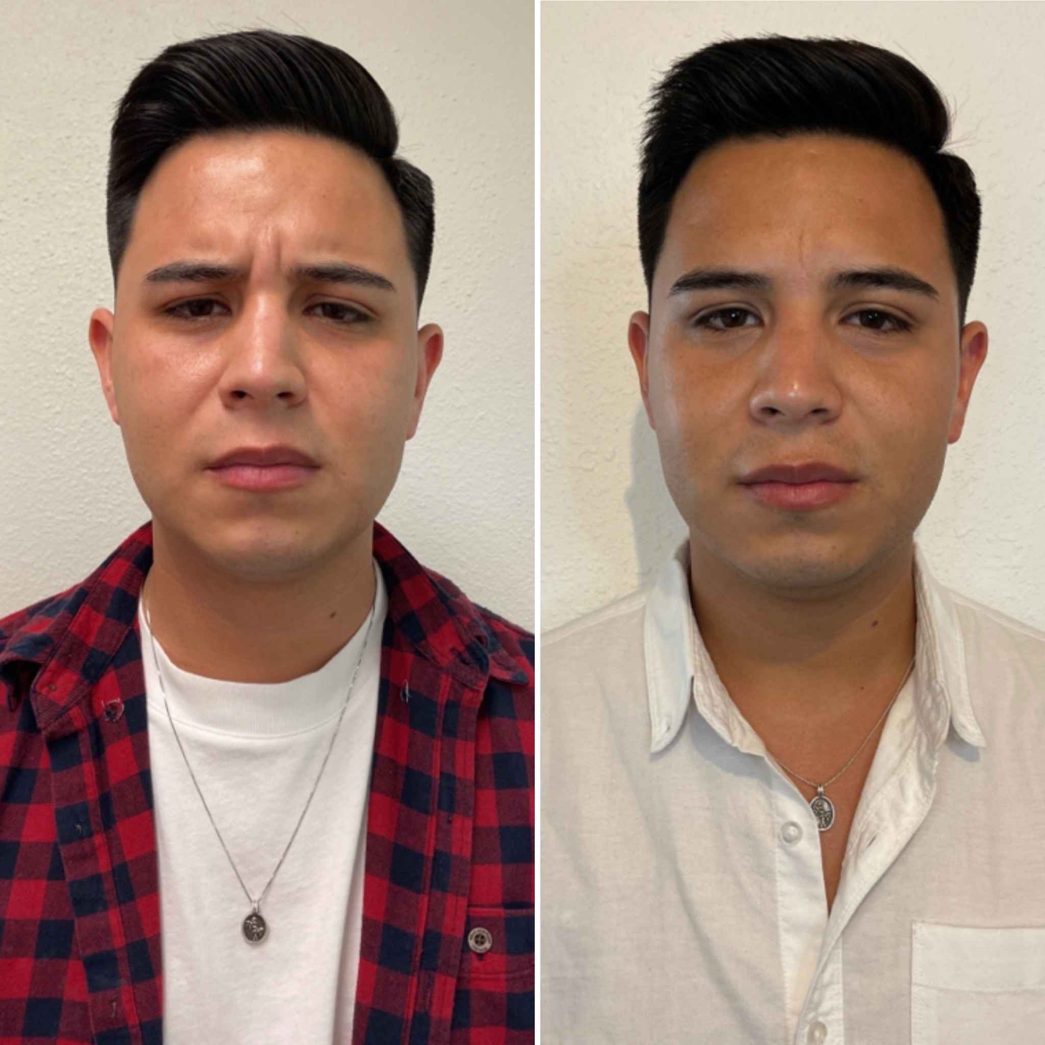 Med Spa Before and After Photos | Onyx Medical Aesthetics WA