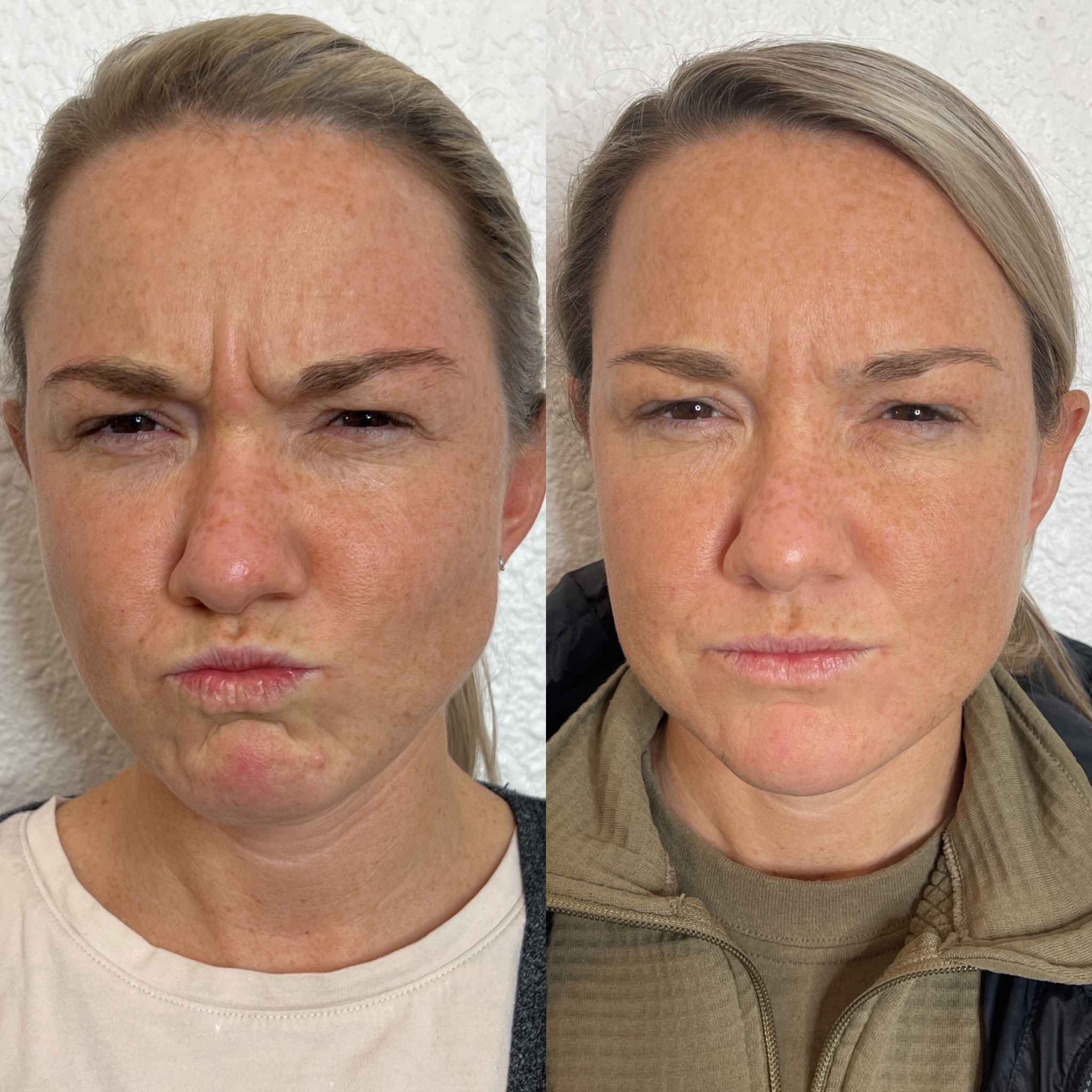 Med Spa Before and After Photos | Onyx Medical Aesthetics WA