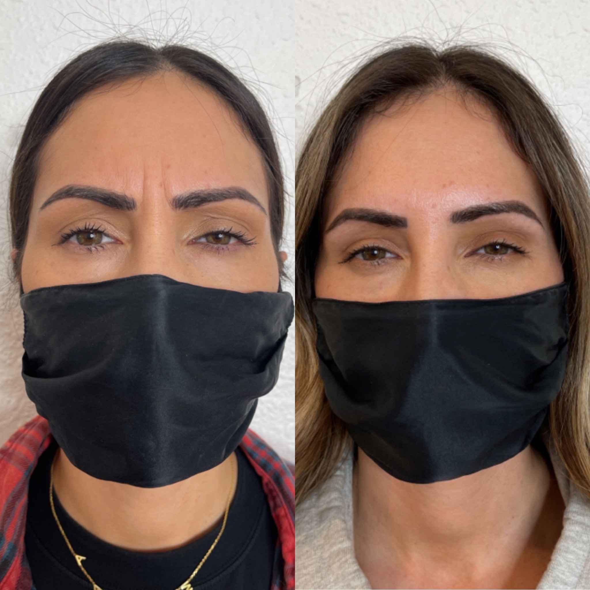 Med Spa Before and After Photos | Onyx Medical Aesthetics WA